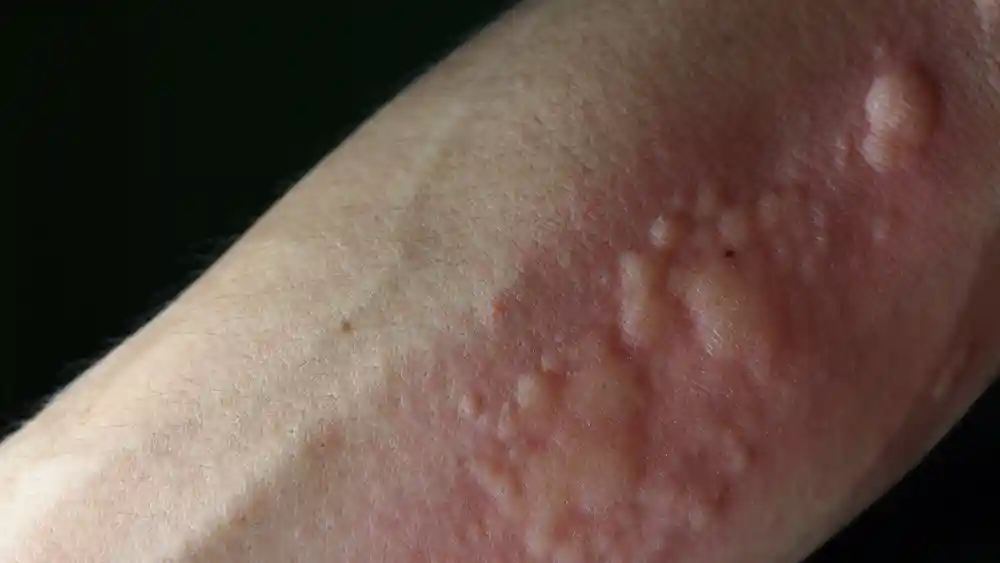 When To Worry About A Rash In Adults Anti Leukemia